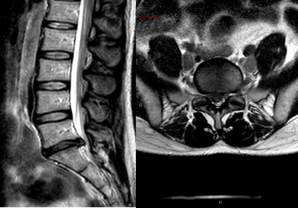 Cauda Equina Syndrome Cauda Equina Syndrome