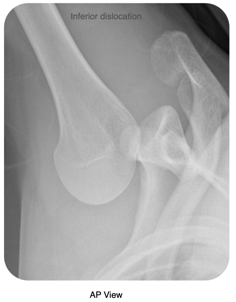 Shoulder Dislocation - OrthoSHO
