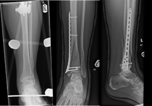 Tibial Fractures (plateau, shaft and pilon) - OrthoSHO